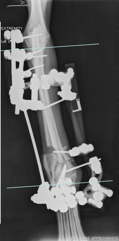 Angular limb deformity - Fitzpatrick Referrals