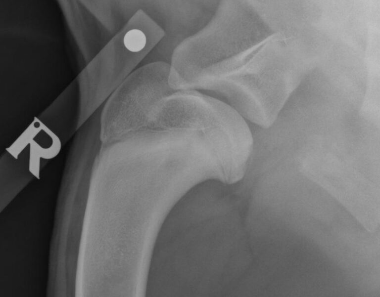 Shoulder osteochondritis dissecans (OCD) - Fitzpatrick Referrals