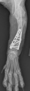 Angular limb deformity - Fitzpatrick Referrals