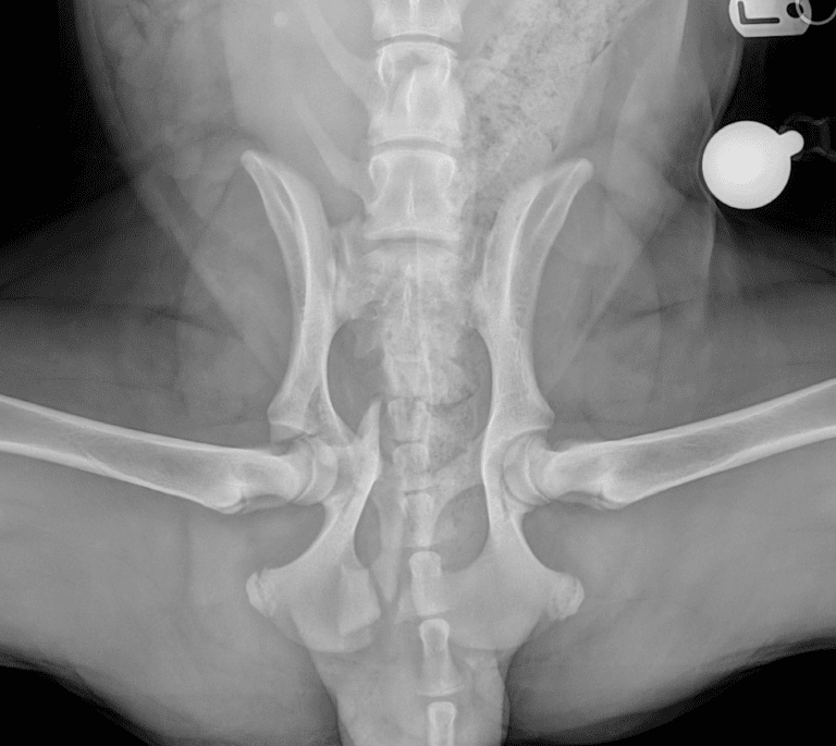 Gibson's pelvic fracture - Fitzpatrick Referrals