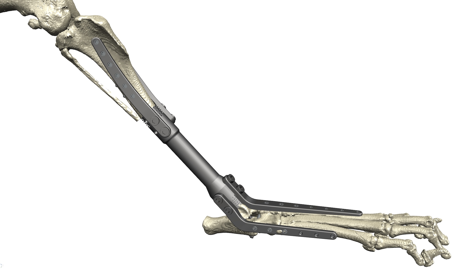 Tibial endoprosthesis for bone cancer - Fitzpatrick Referrals