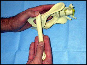 Displasia de cadera - Fitzpatrick Referrals | Carlos Ramirez